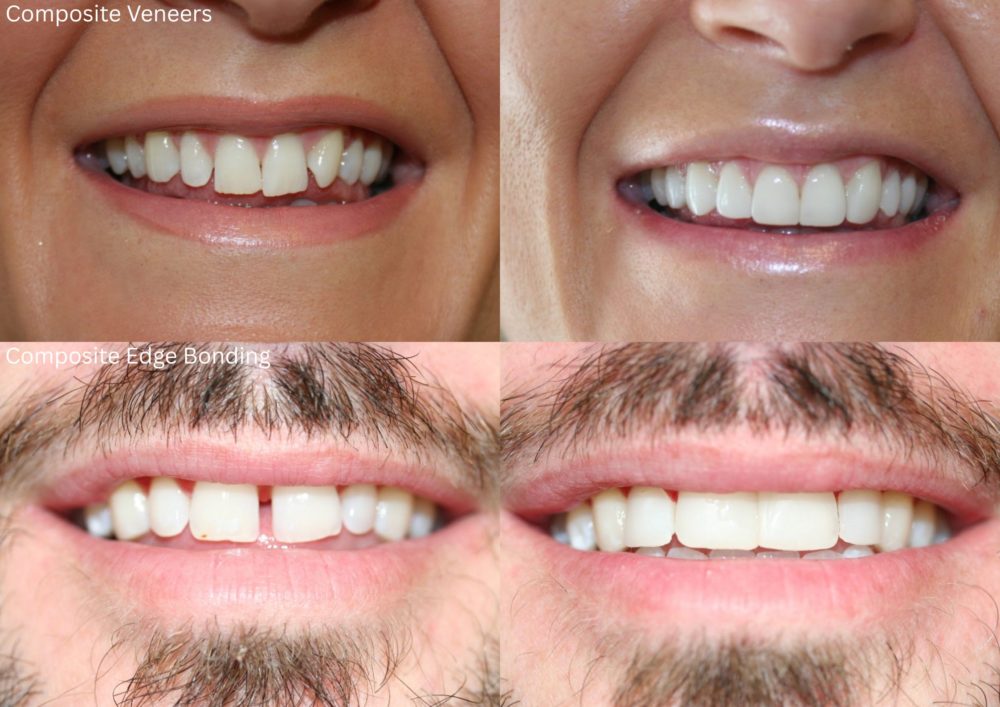 Composite Veneers & Bonding - Zen Clinic